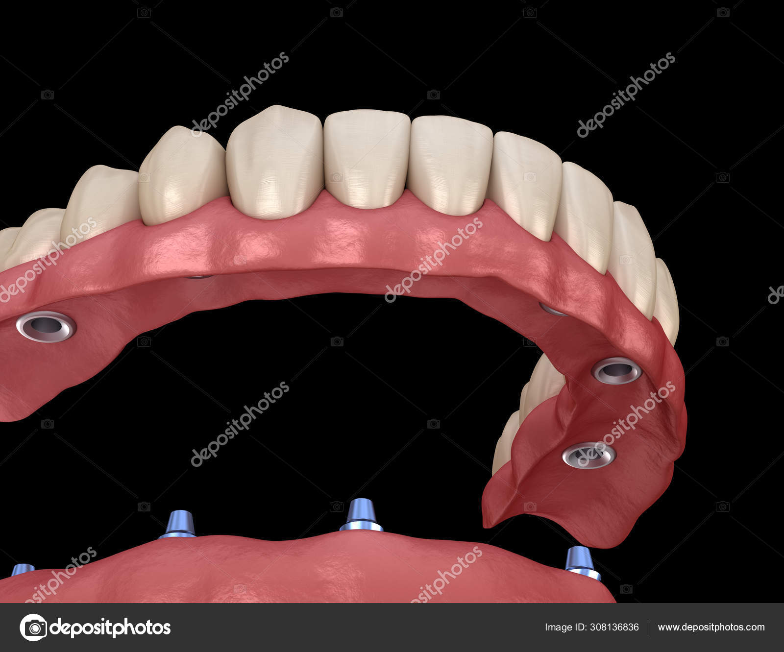 Mandibular Prosthesis Gum All System Supported Implants Medically ...