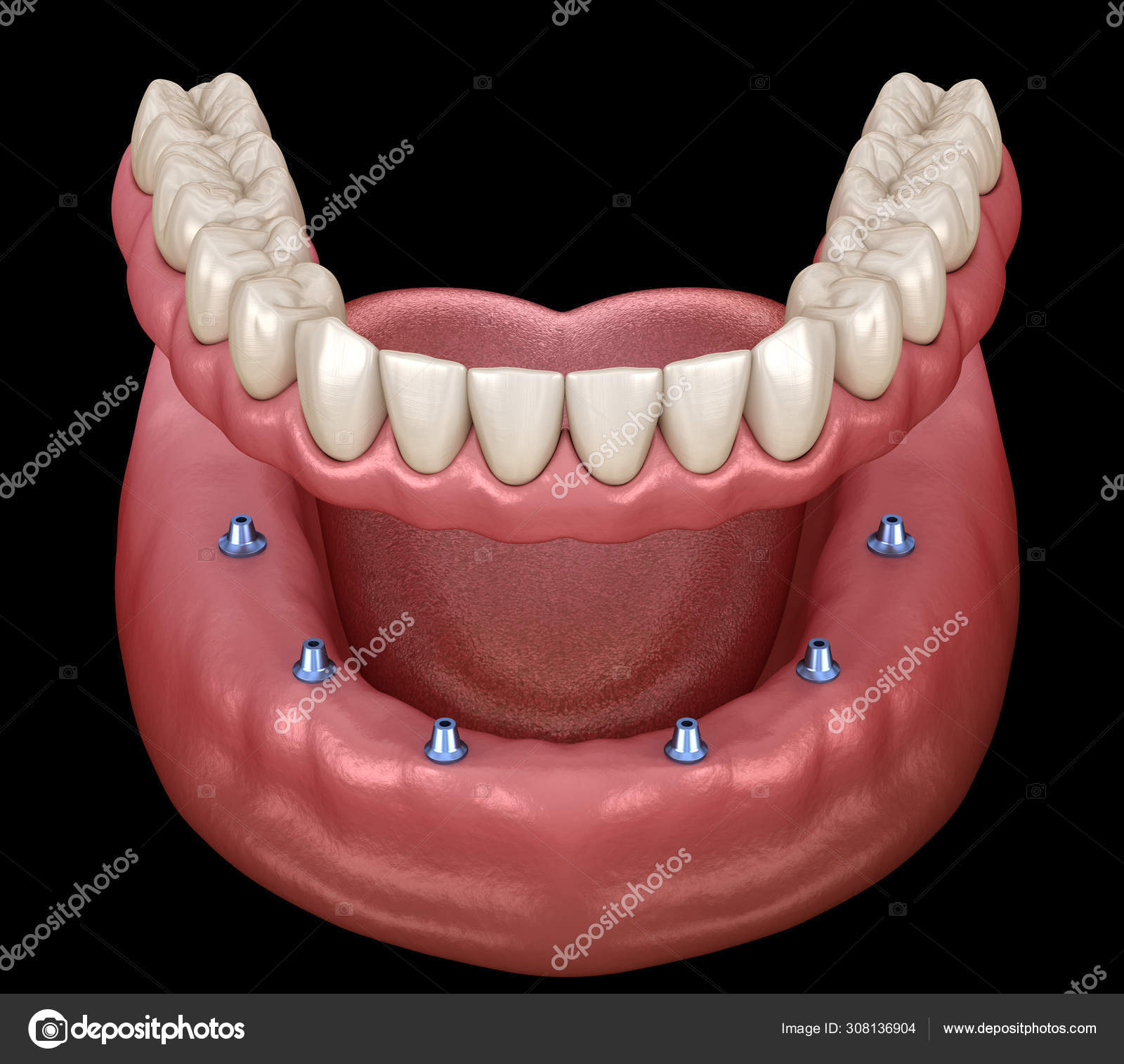 Mandibular Prosthesis Gum All System Supported Implants Medically ...