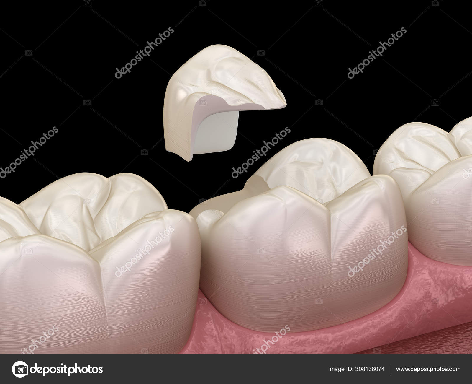 Onlay Ceramic Crown Fixation Tooth Medically Accurate Illustration ...