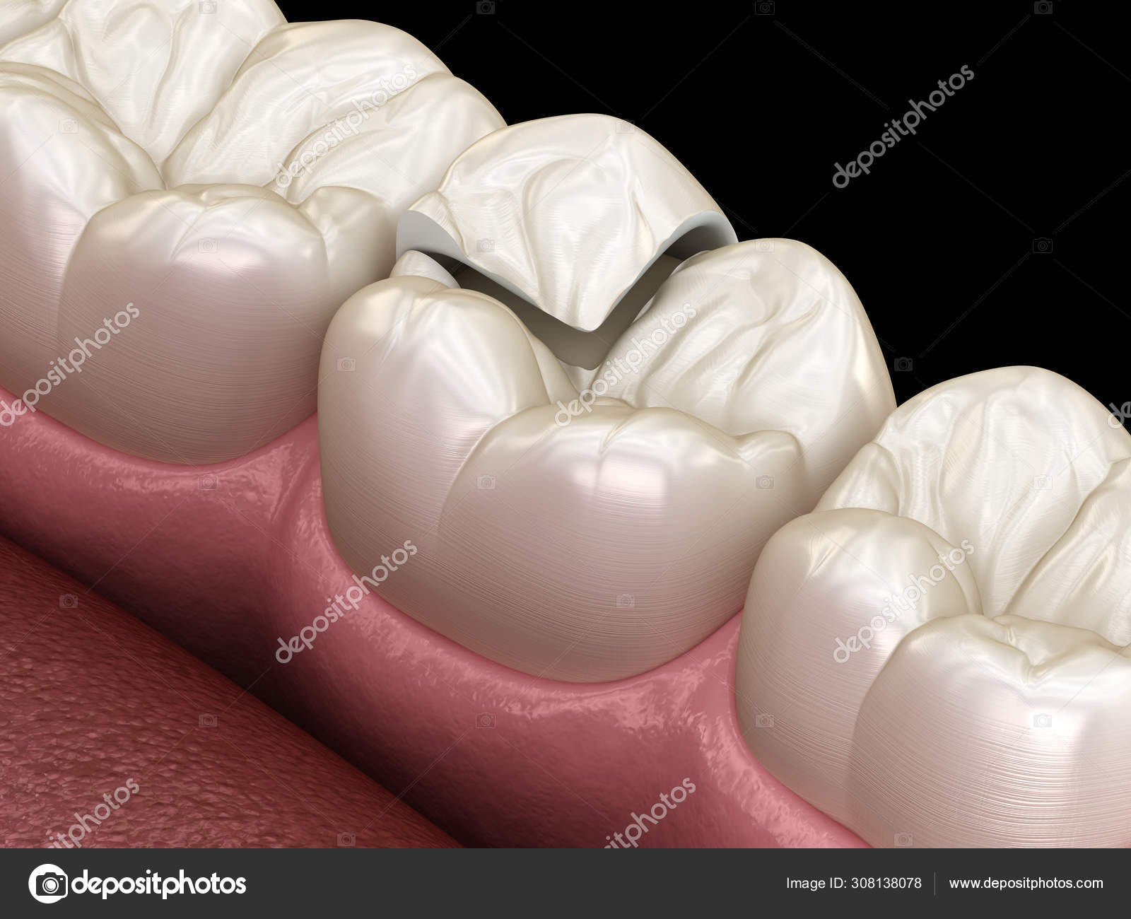 Onlay Ceramic Crown Fixation Tooth Medically Accurate Illustration ...