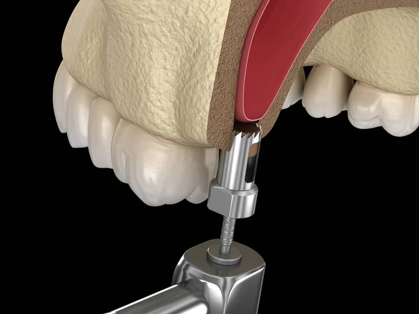 Cirugía de elevación sinusal: creación de un acceso al seno ...