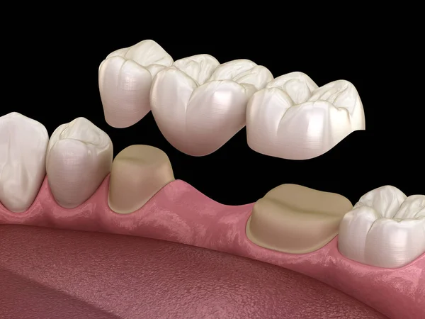 Dental bridge Stock Photos, Royalty Free Dental bridge Images ...