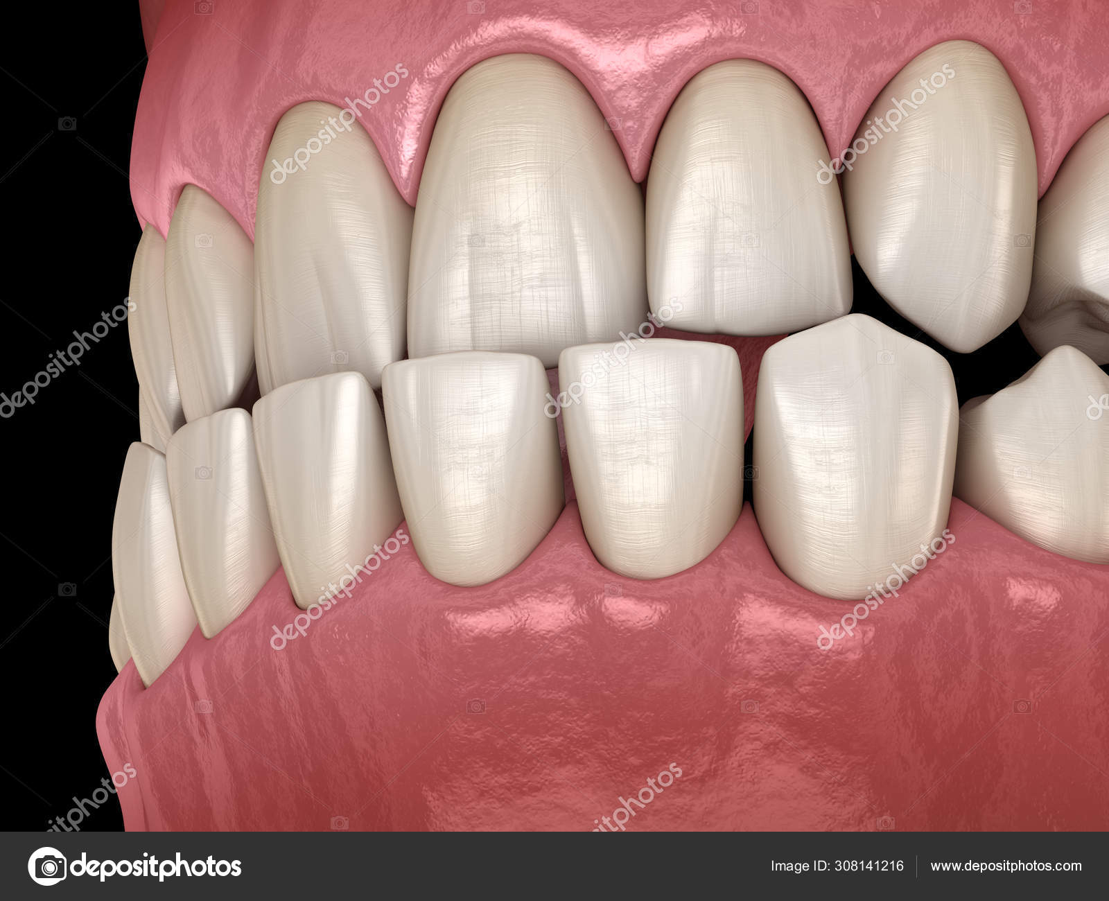 Underbite Dental Occlusion Malocclusion Teeth Medically Accurate Tooth ...