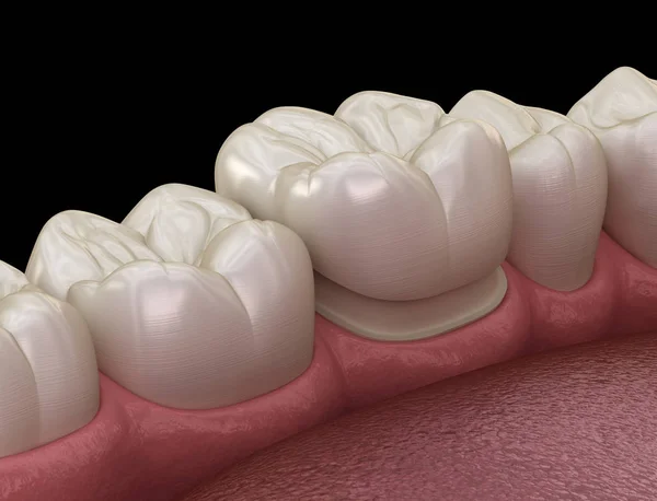 Onlay Ceramic Crown Fixation Tooth Medically Accurate Illustration ...