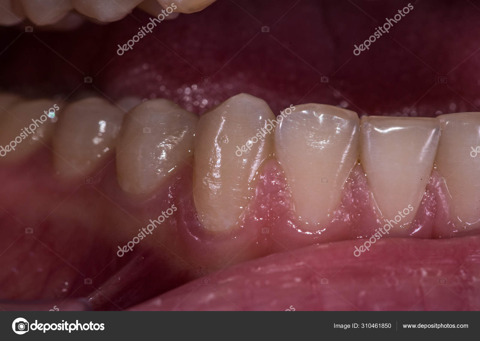 Healthy Human Premolar Teeth Close View Stock Photo by ©Alexmit 310461850