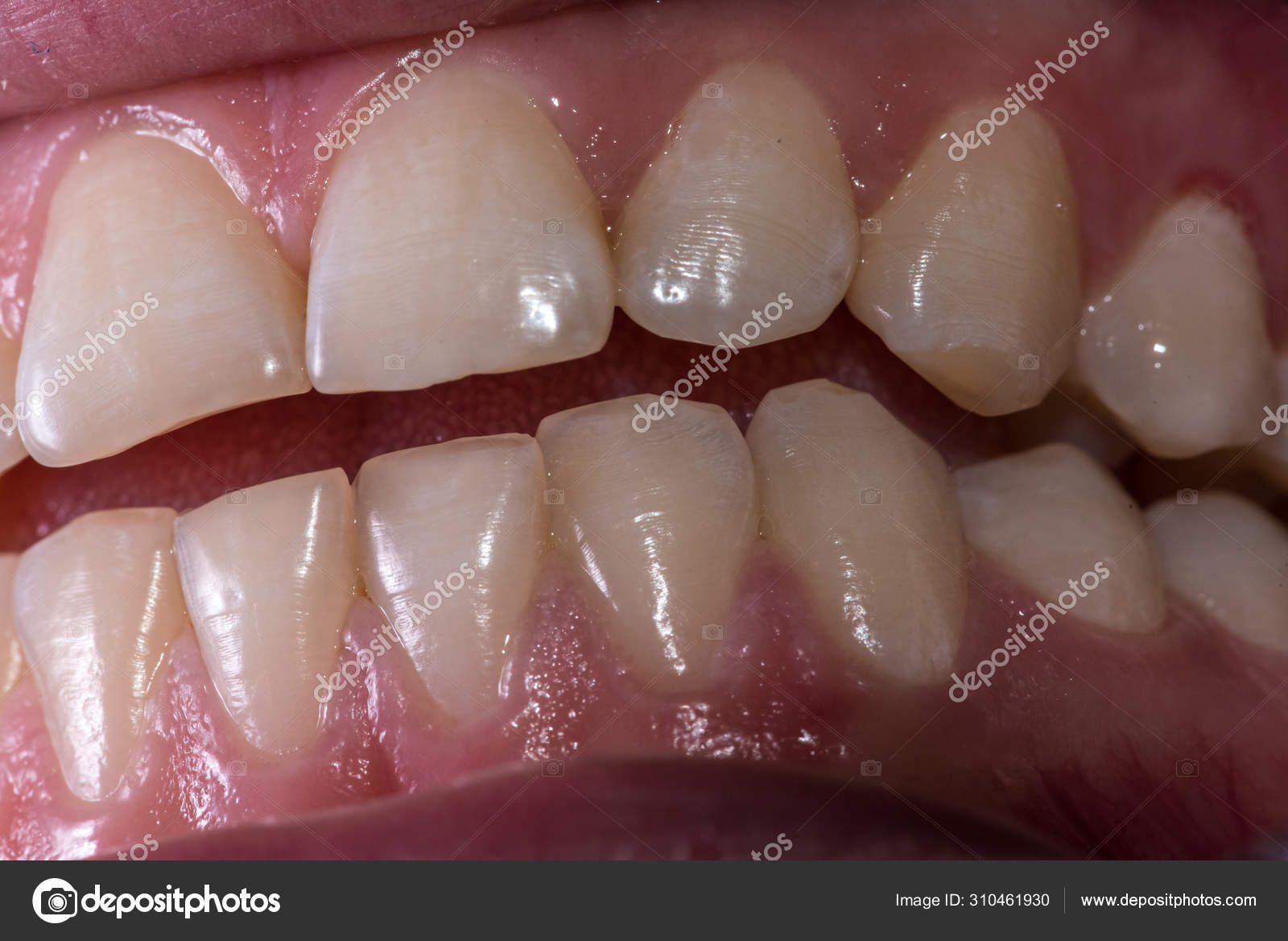 Dientes Humanos Sanos Incisivos Vista Frontal Cerca — Foto de stock ...