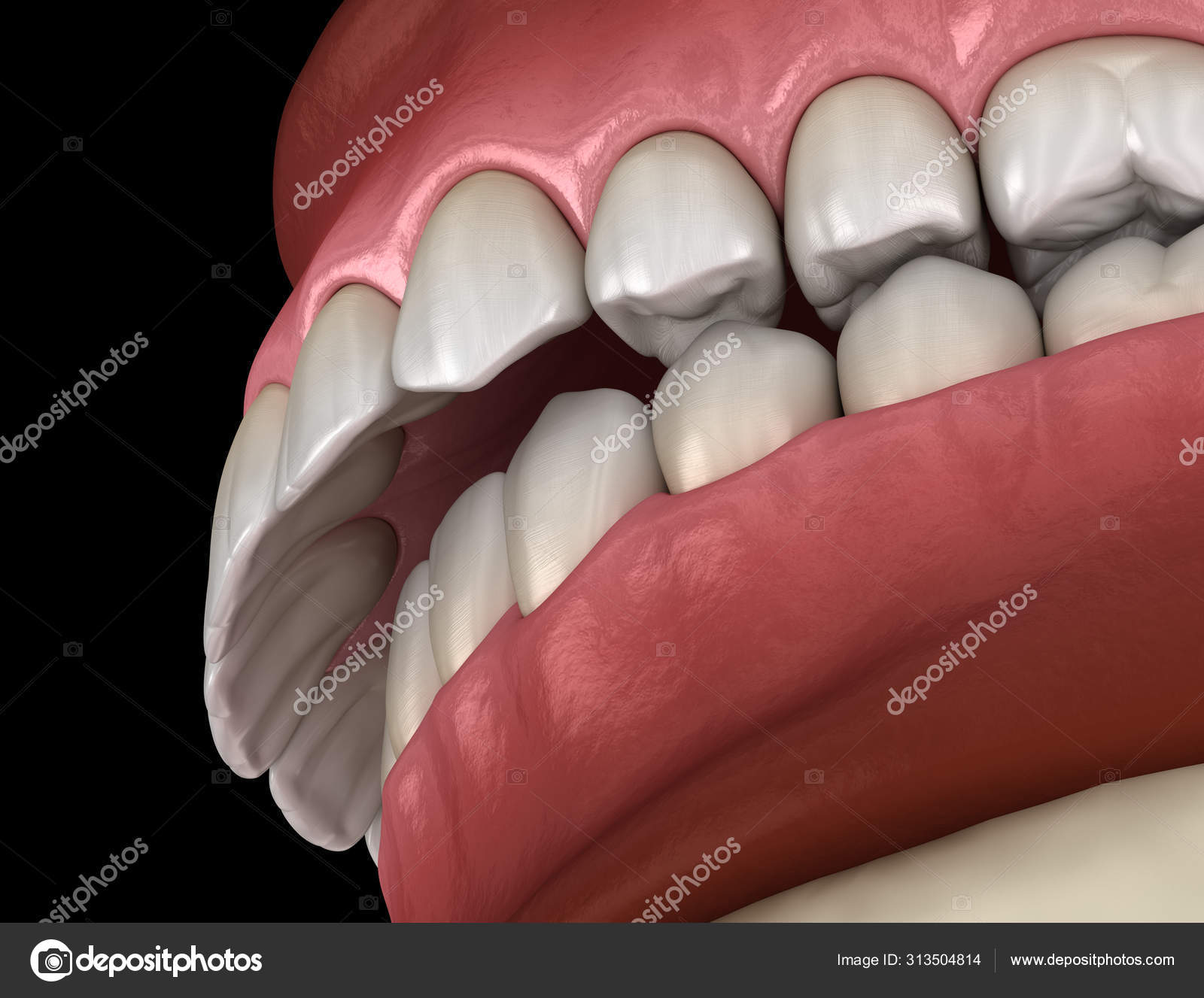 Overbite Dental Occlusion Malocclusion Teeth Medically Accurate Tooth ...