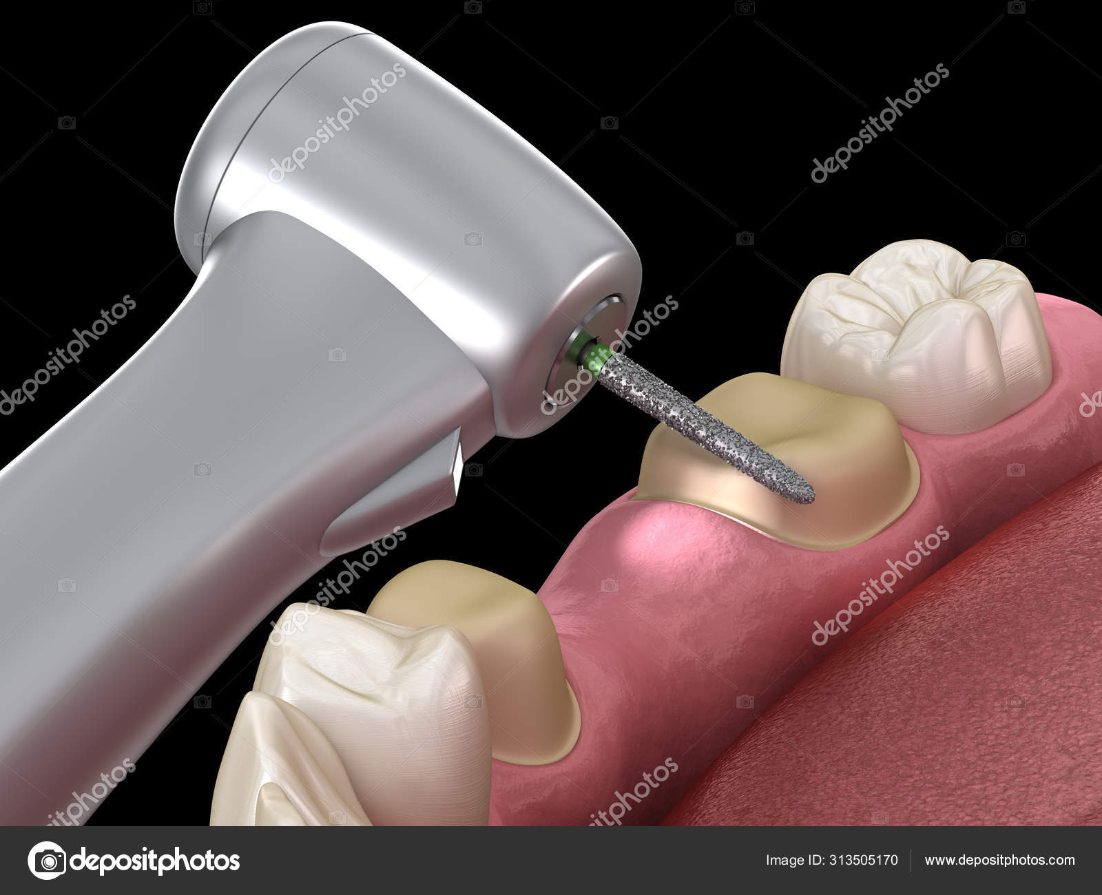 Premolar Preparation Process Dental Crown Placement Medically Accurate ...
