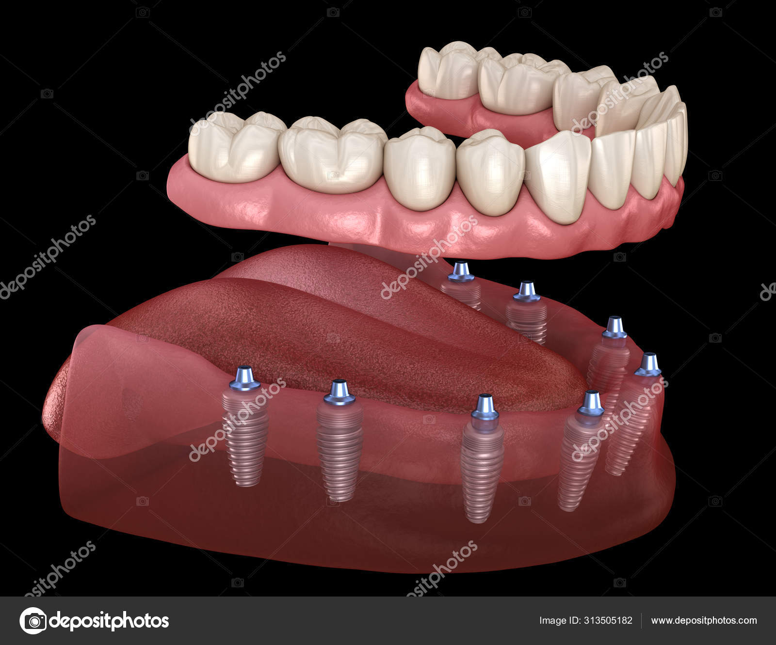 Mandibular Prosthesis All System Supported Implants Medically Accurate ...