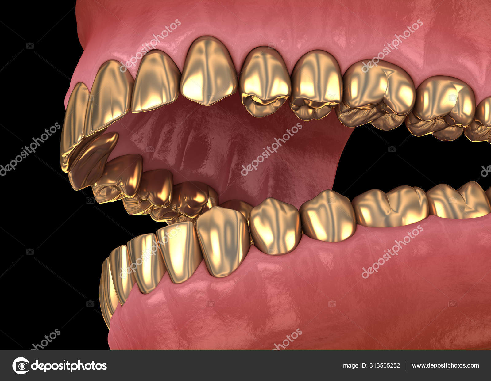 Natural Fangs In Humans