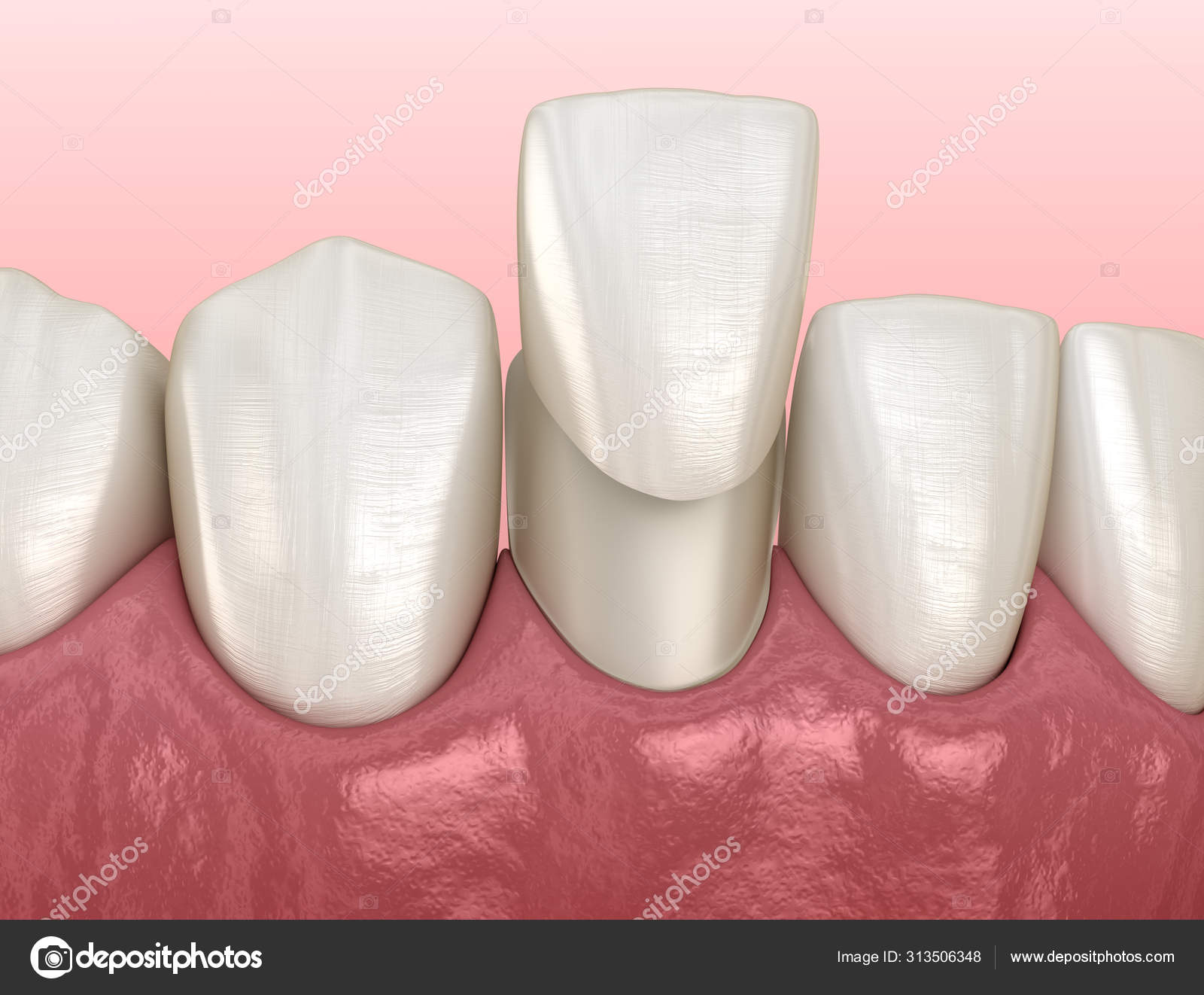 Verlegung Der Kieferfurniere Über Den Seitlichen Schneidezahn ...