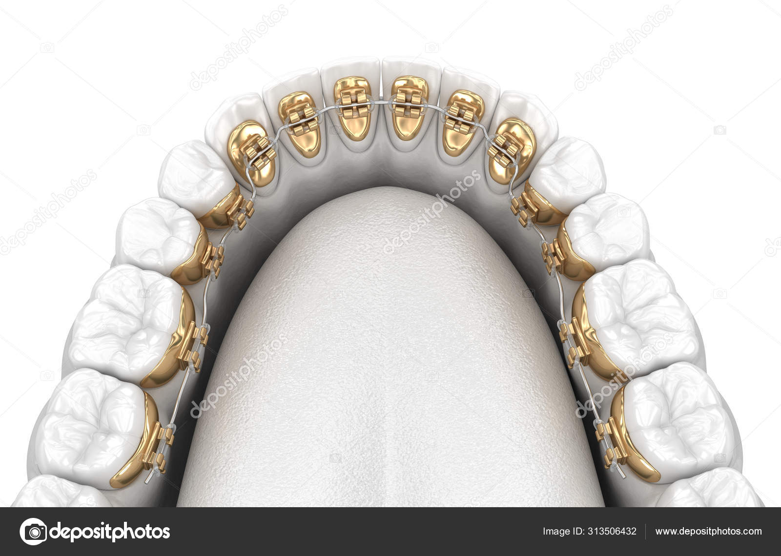 Lingual Braces System Illustration Concept Golden Braces Stock Photo by ...