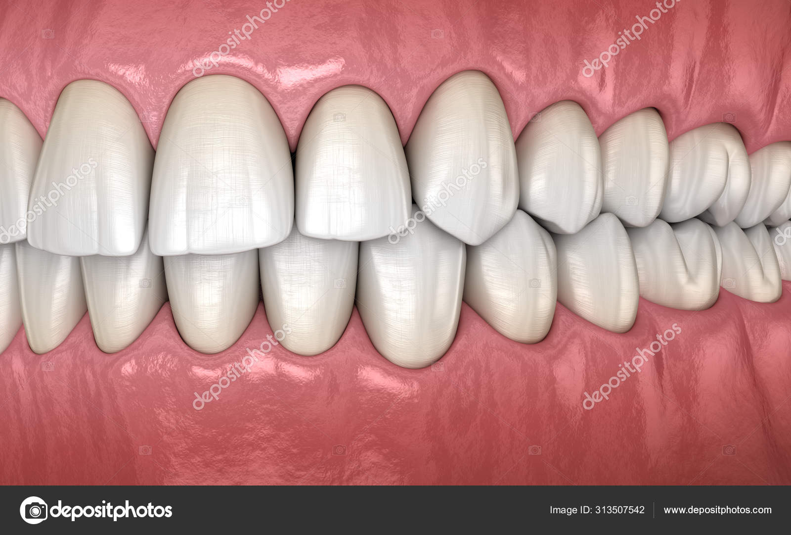 Healthy Human Teeth Normal Occlusion Side View Medically Accurate Tooth ...
