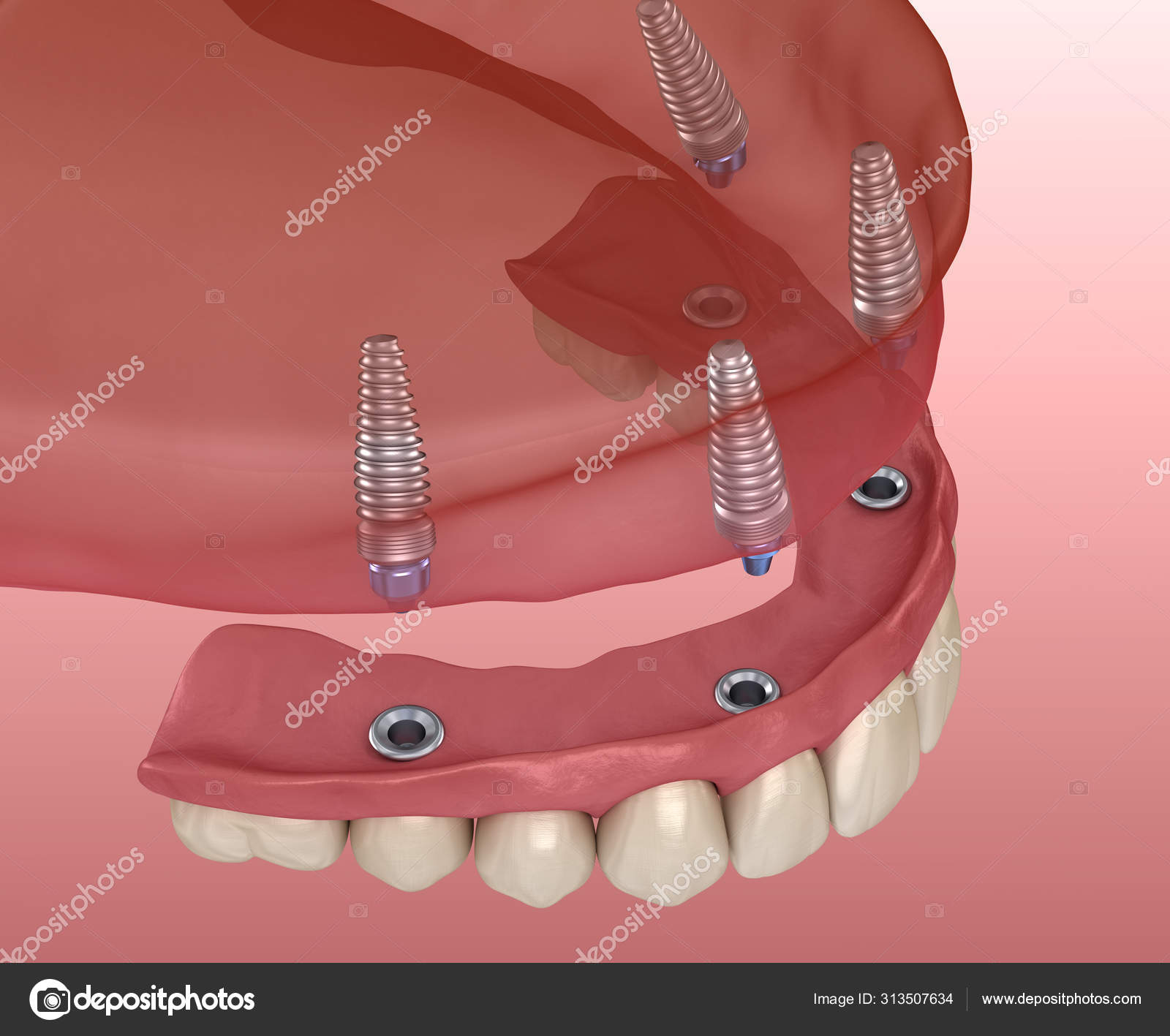 Maxillary Prosthesis Gum All System Supported Implants Medically ...