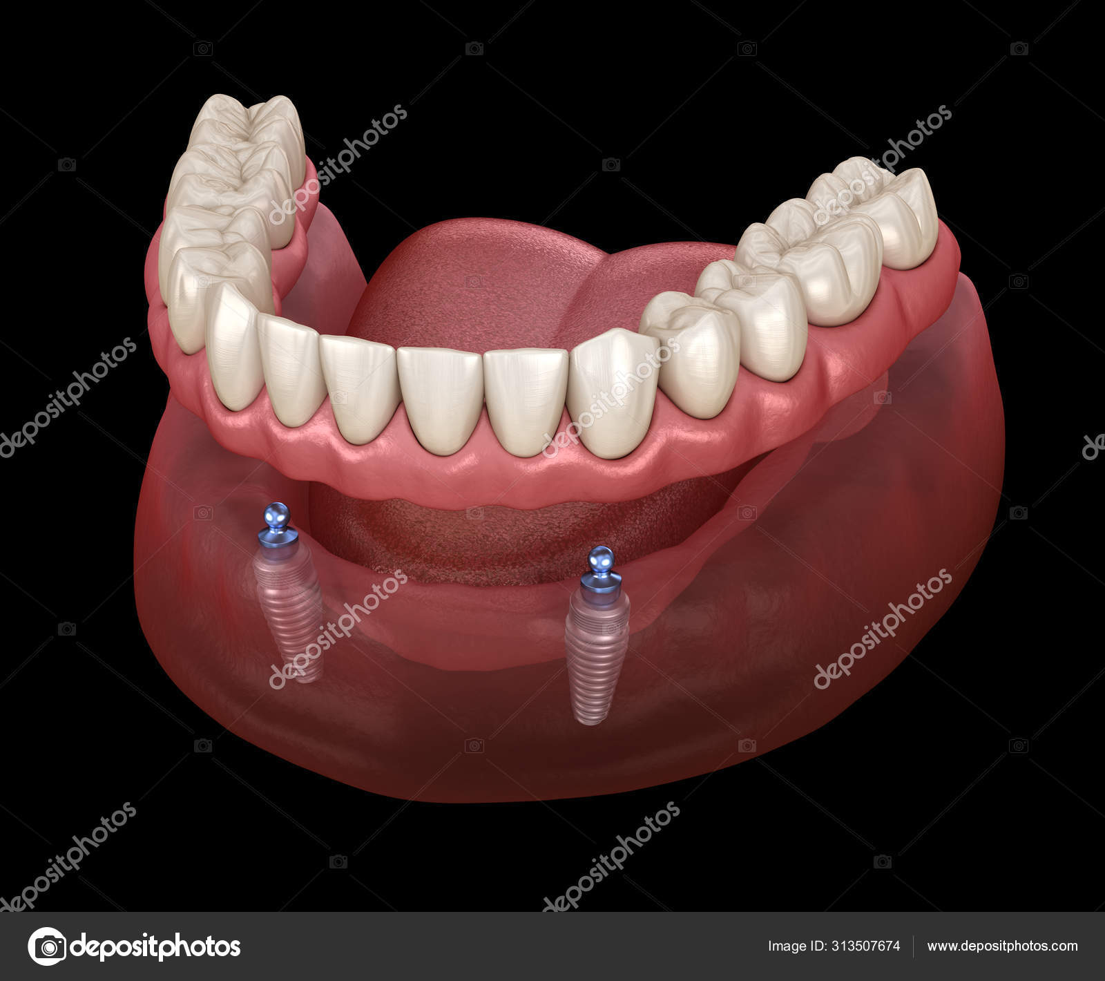 Protesi Parziale Rimovibile Mandibolare
