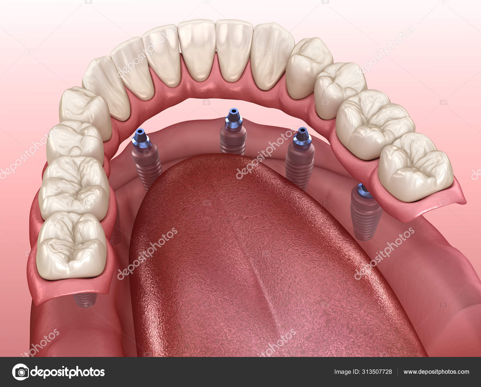 Mandibular Prosthesis Gum All System Supported Implants Medically ...