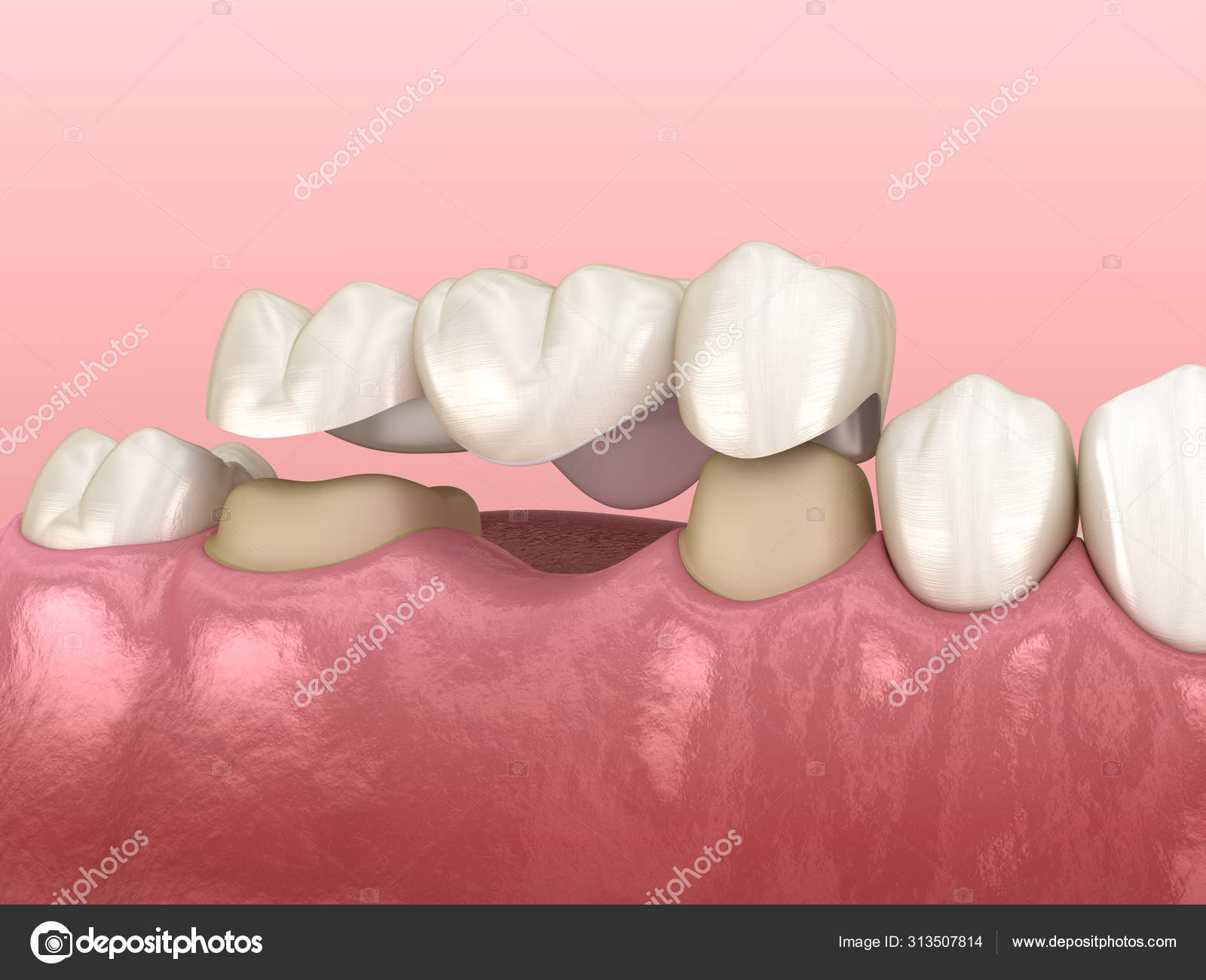 Dental Bridge Teeth Molar Premolar Medically Accurate Illustration ...