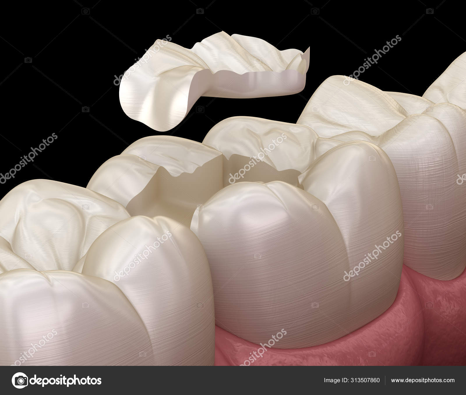 Inlay Ceramic Crown Fixation Tooth Medically Accurate Illustration ...