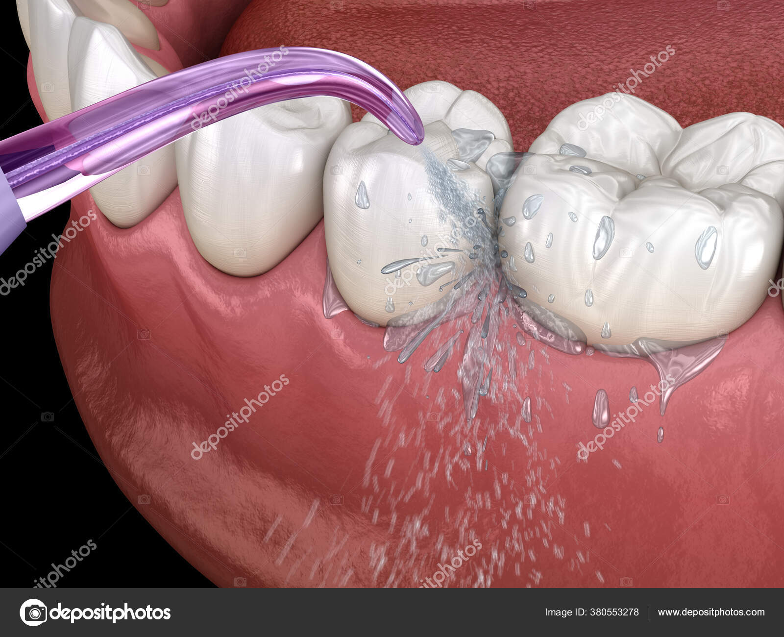 Irrigator Water Teeth Cleaning Medically Accurate Illustration Oral ...