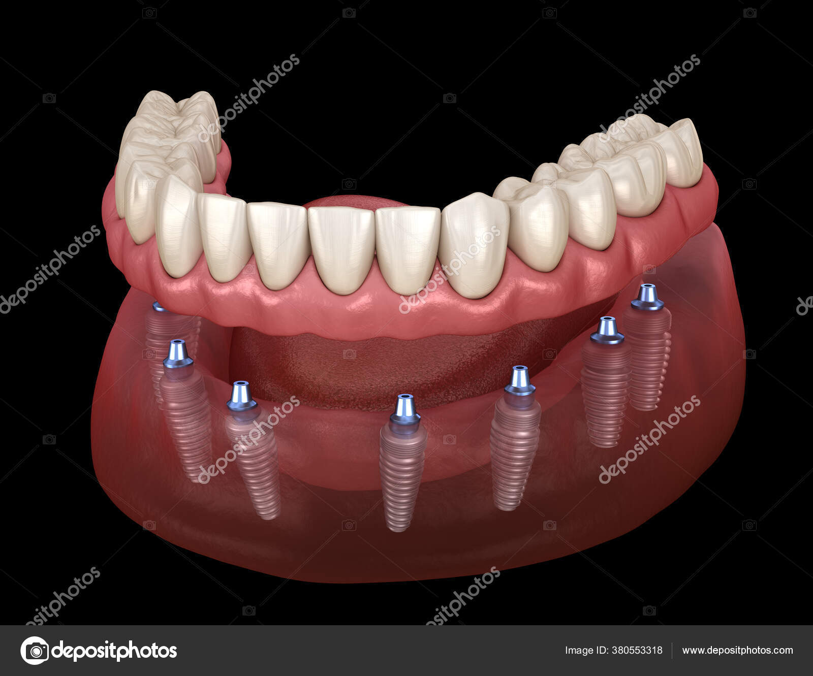 Mandibular Prosthesis All System Supported Implants Medically Accurate ...