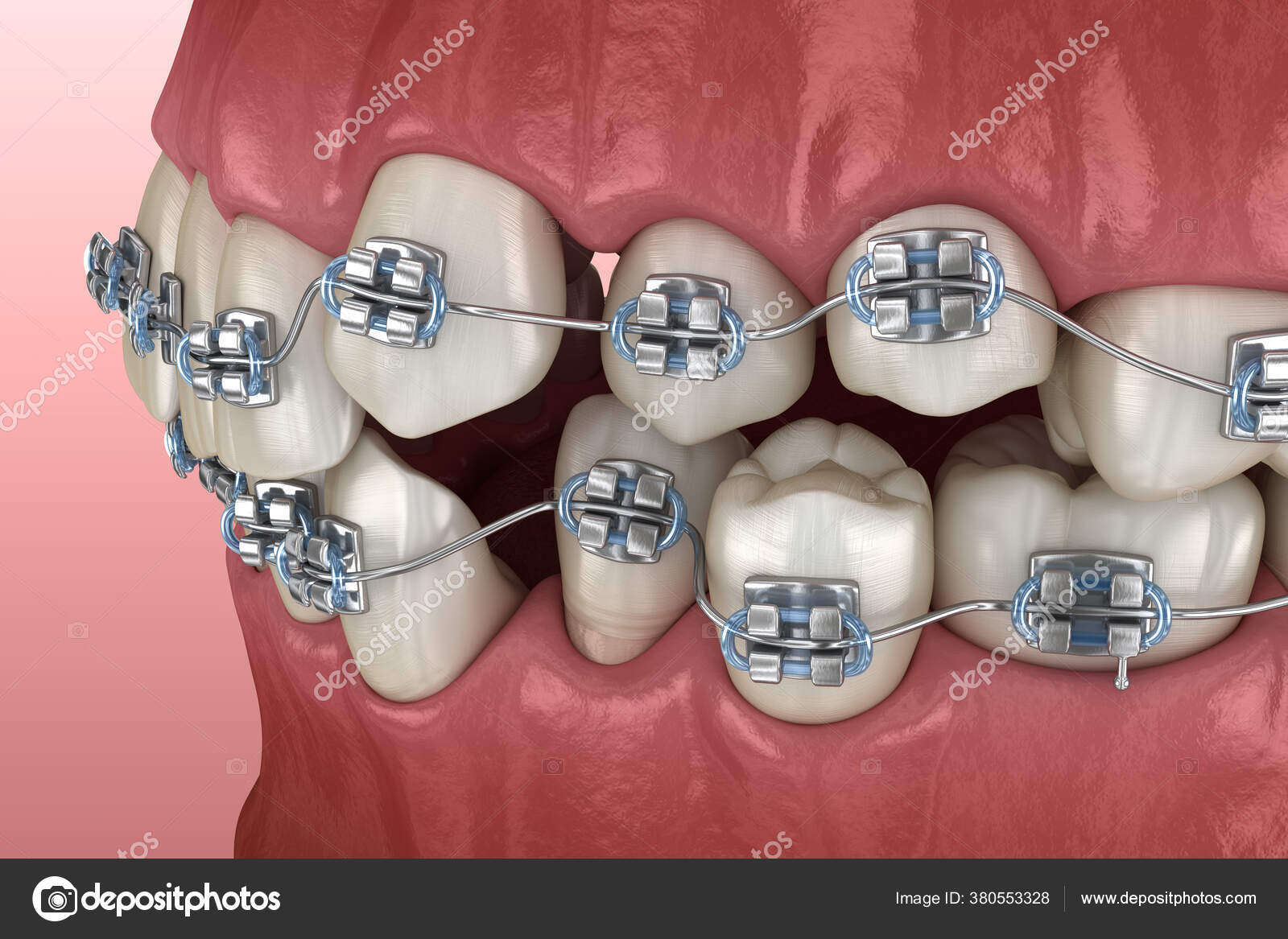 Abnormal Teeth Position Metal Braces Tretament Medically Accurate ...