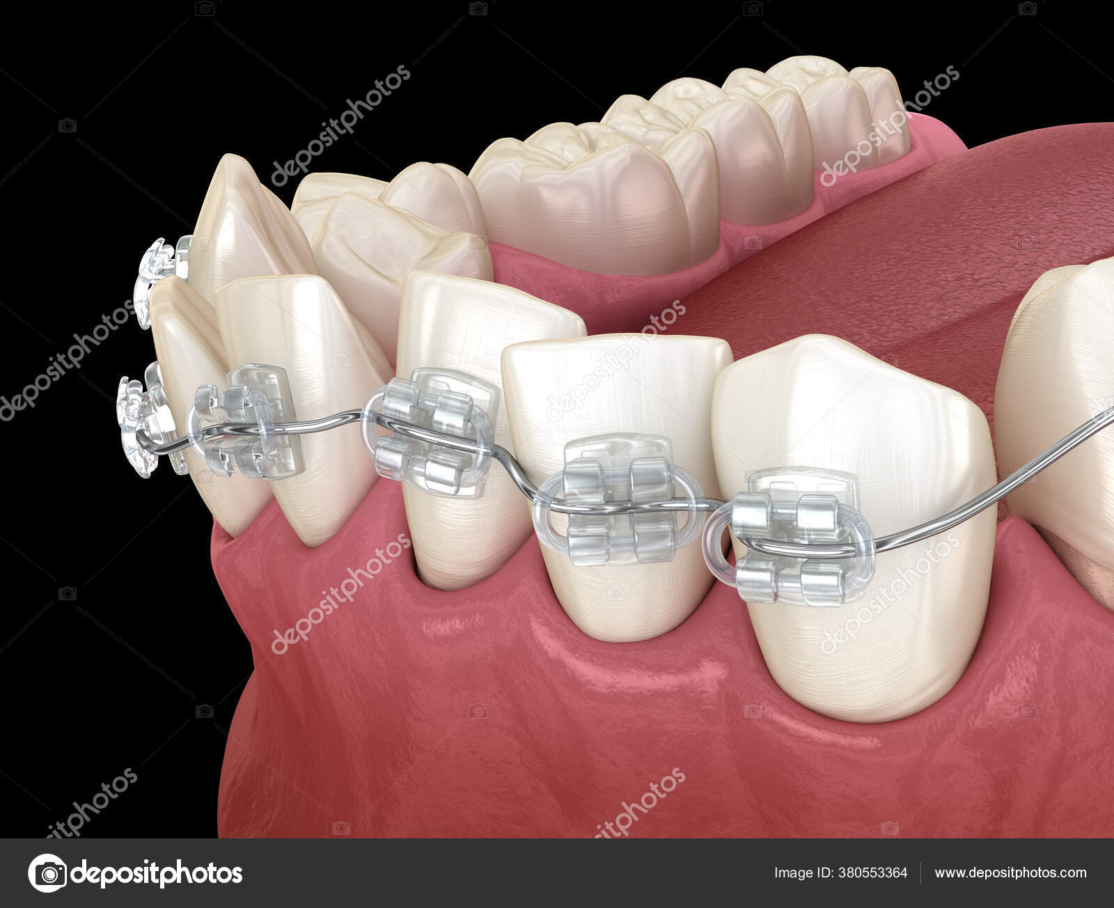Abnormal Teeth Position Clear Braces Tretament Medically Accurate ...