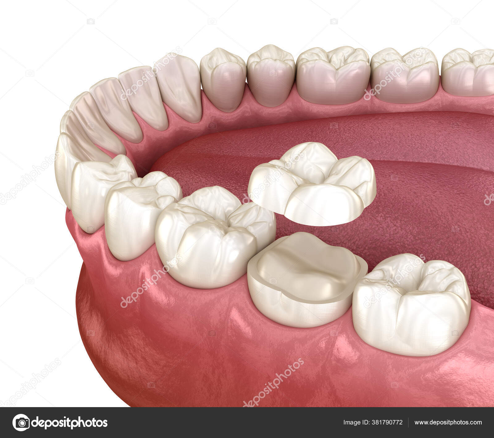 Onlay Ceramic Crown Fixation Molar Tooth Medically Accurate ...