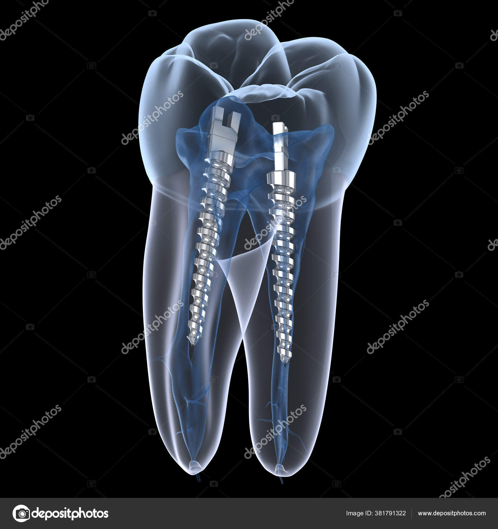 Dental Steel Post Molar Teeth Xray View Dental Endodontic Treatment ...