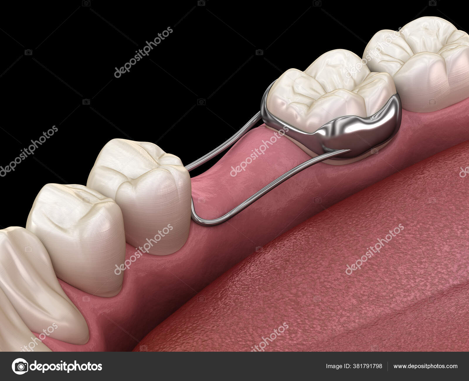 Space Maintainer Unilateral Keeps Teeth Shift Deformatiuon Losing Molar ...