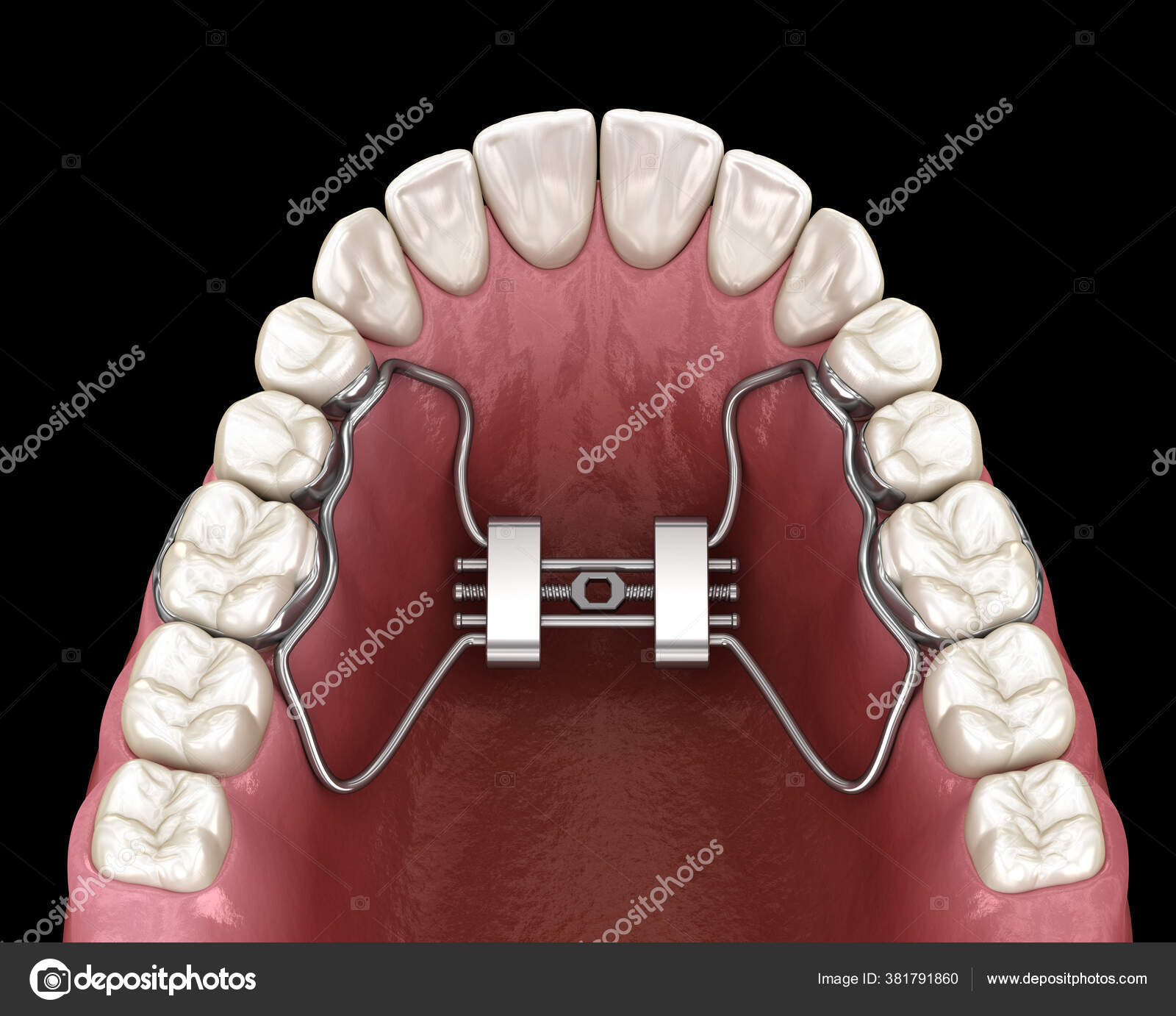 Rapid Palatal Expansion Medically Accurate Tooth Illustration — Stock ...
