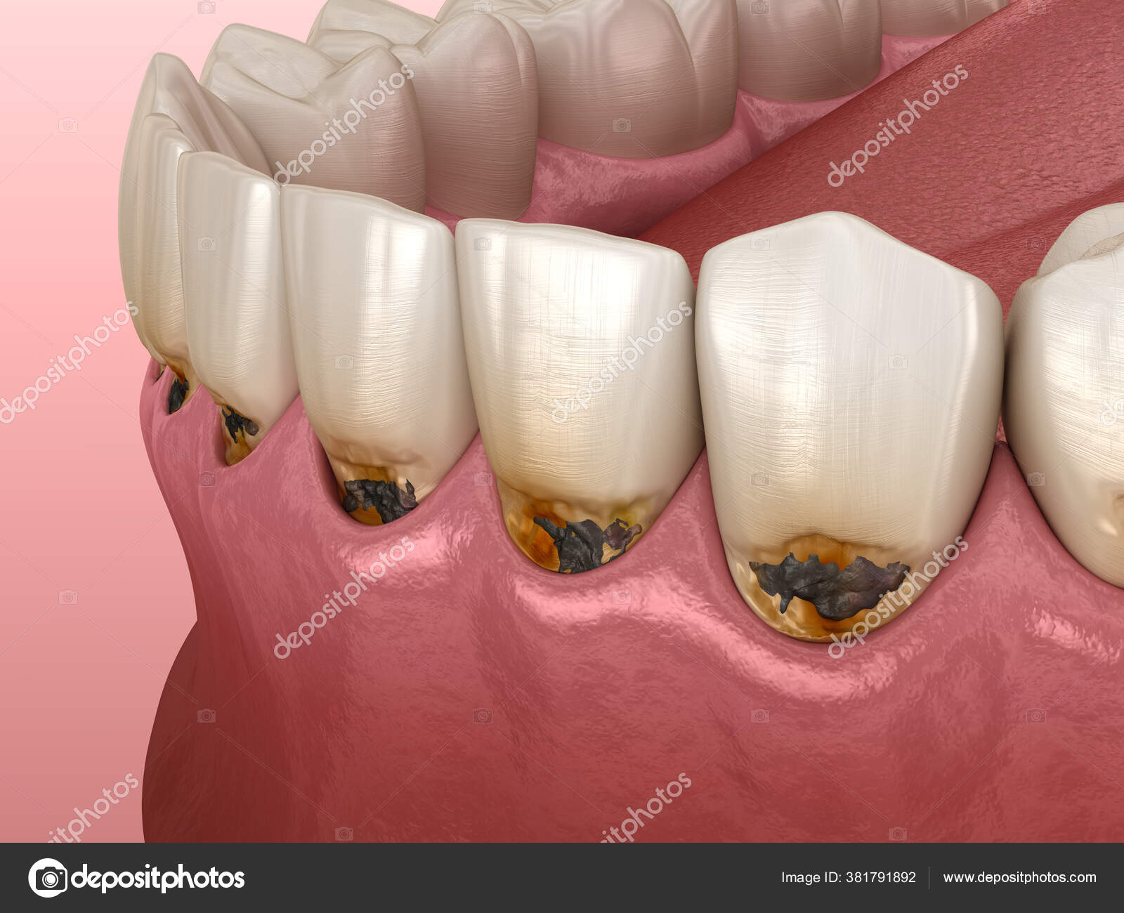 Cervical Caries Frontal Teeth Medically Accurate Tooth Illustration ...