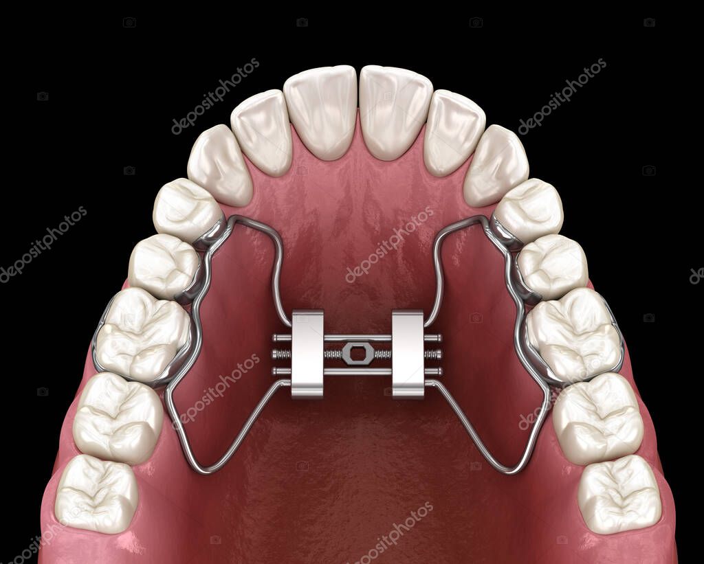 Expansión palatina rápida. Ilustración 3D de dientes médicamente ...
