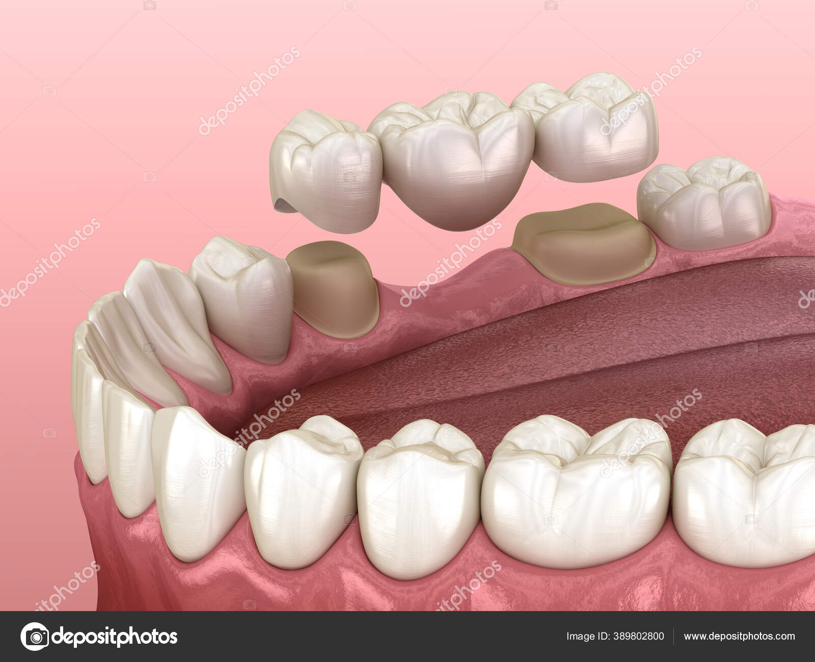 Dental Bridge Teeth Molar Premolar Medically Accurate Illustration ...