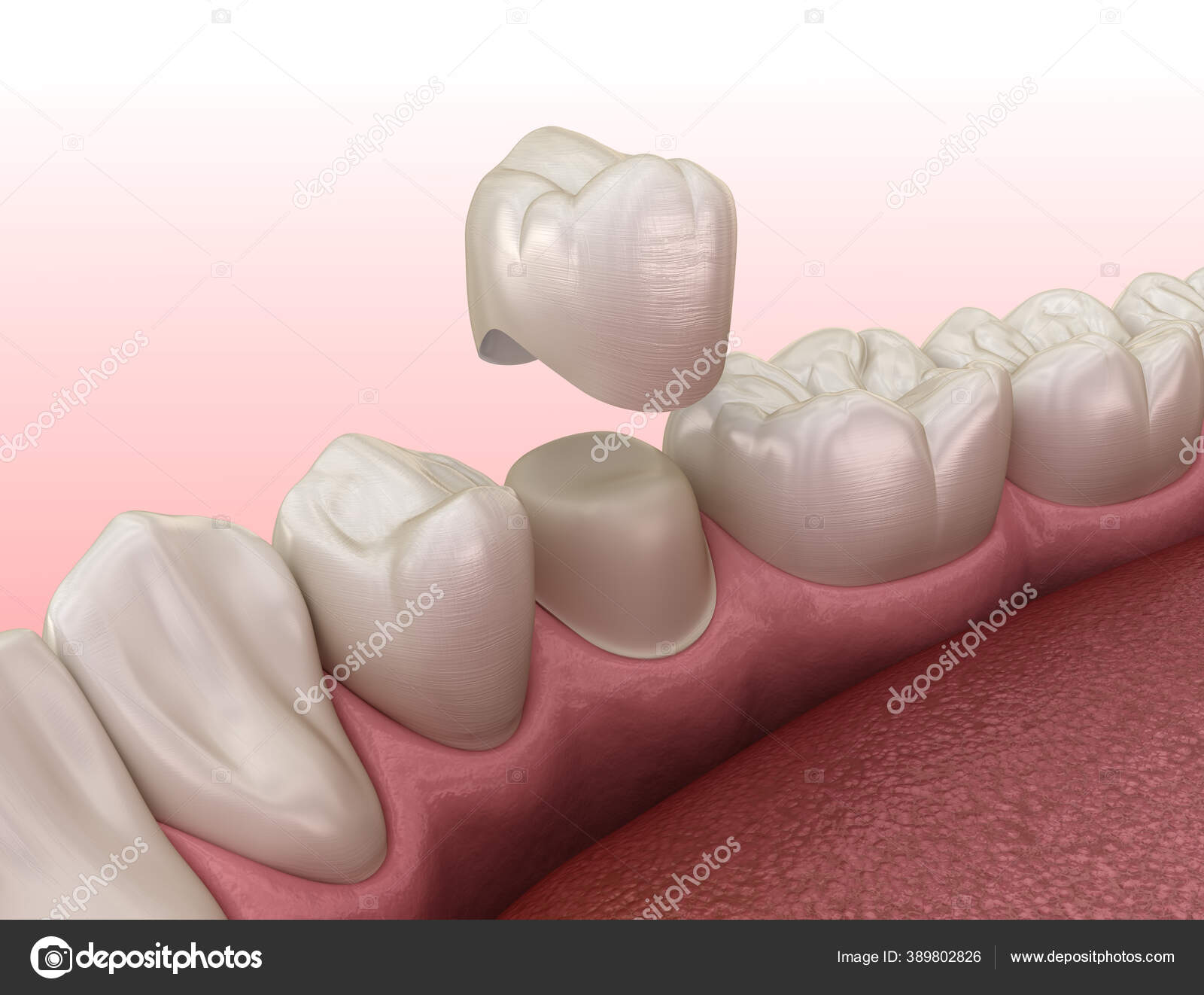 Préparation Dent Prémolaire Placement Couronne Dentaire Illustration ...