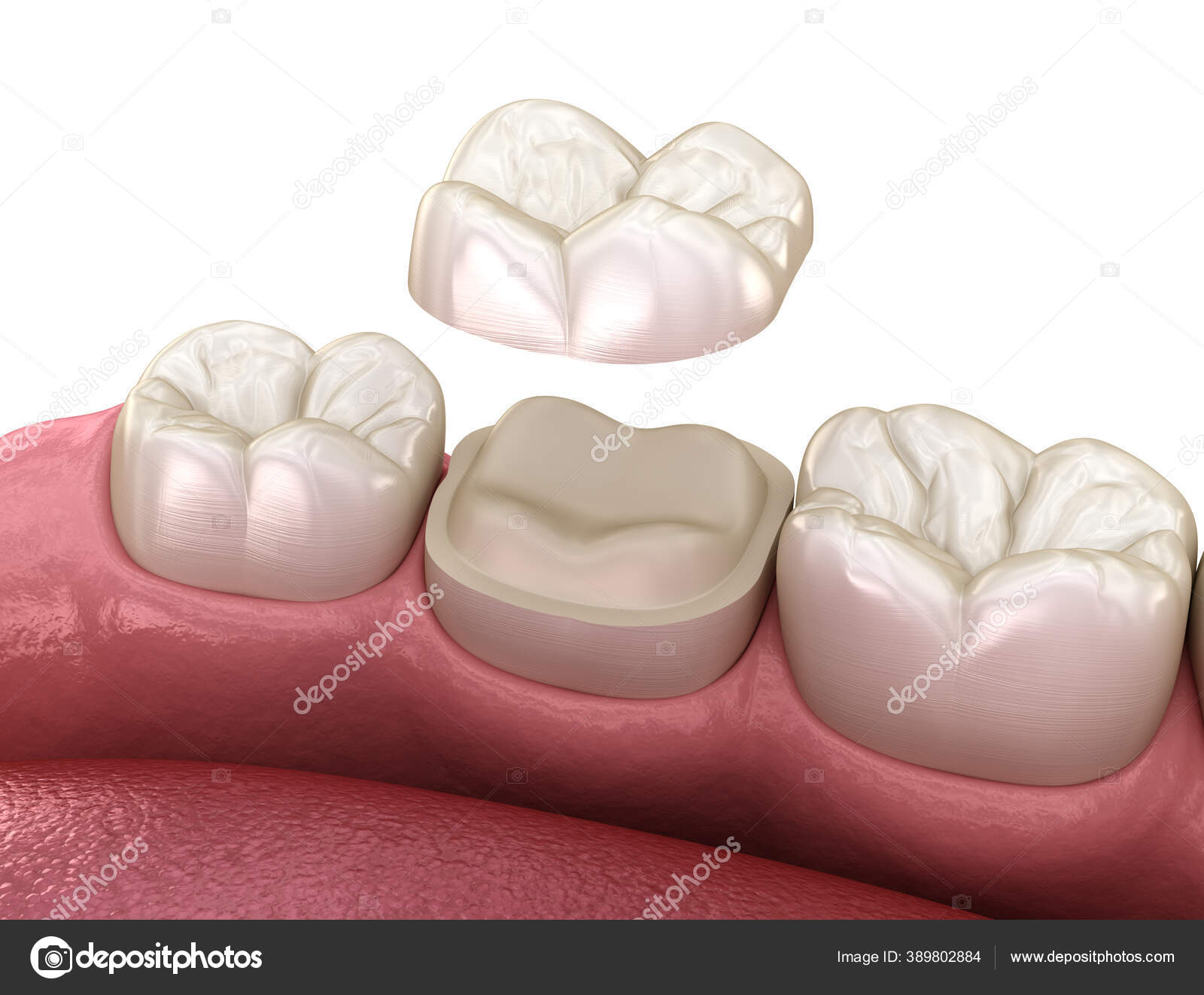 Preparation Onlay Ceramic Crown Fixation Tooth Medically Accurate ...