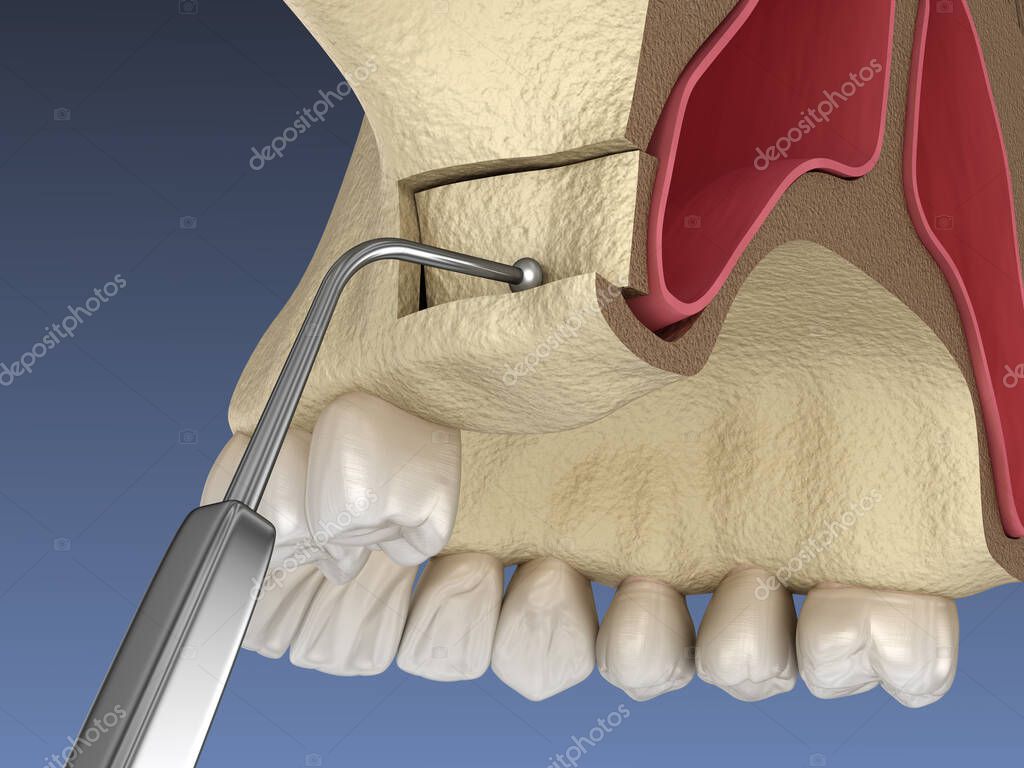 Cirugía de elevación sinusal: creación de acceso lateral al seno ...