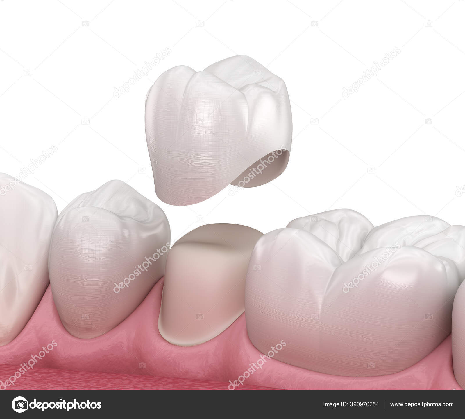 Preparated Premolar Tooth Dental Crown Placement Medically Accurate ...