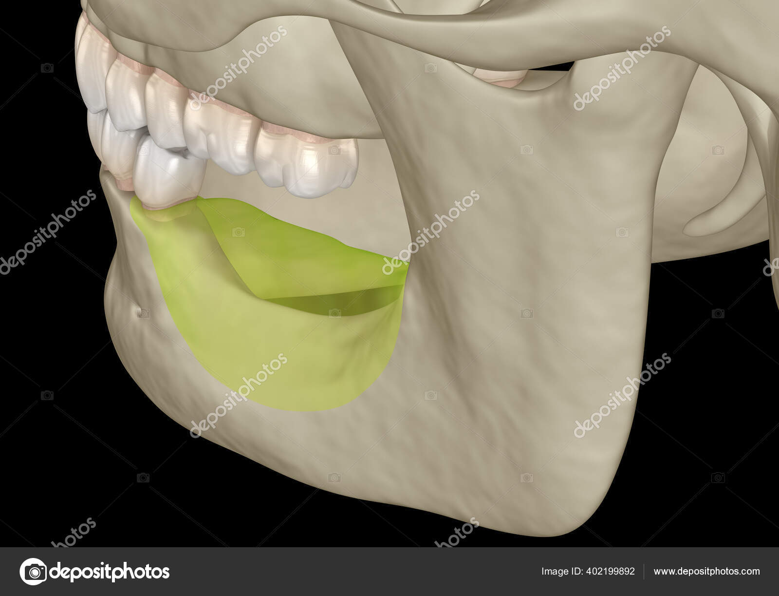 Mandíbula Mandibular Recesión Ósea Después Perder Los Dientes Molares ...