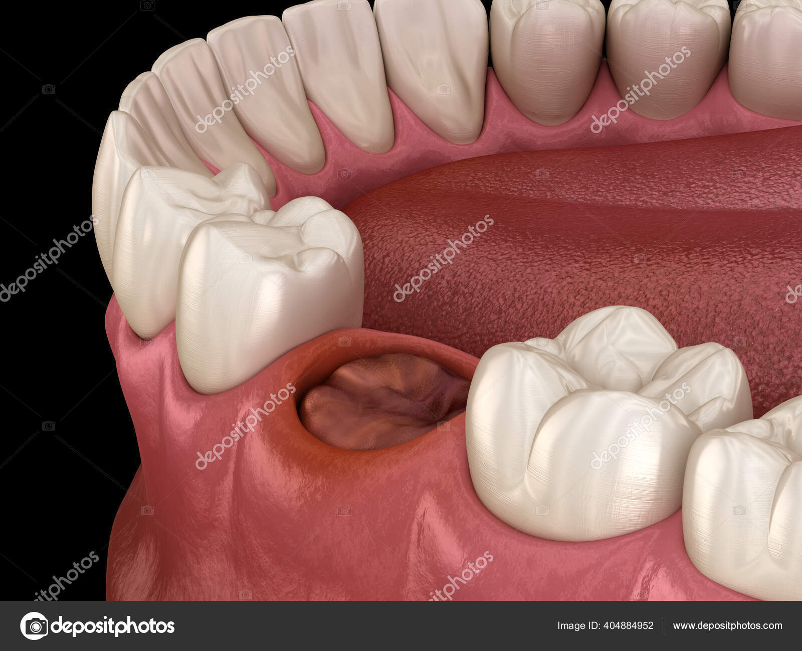 Healthy Wisdom Tooth Socket