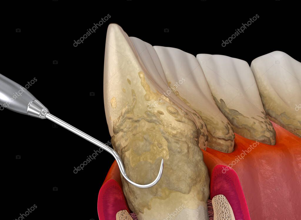 Higiene oral: Escalado y cepillado radicular de Periodontitis en ...