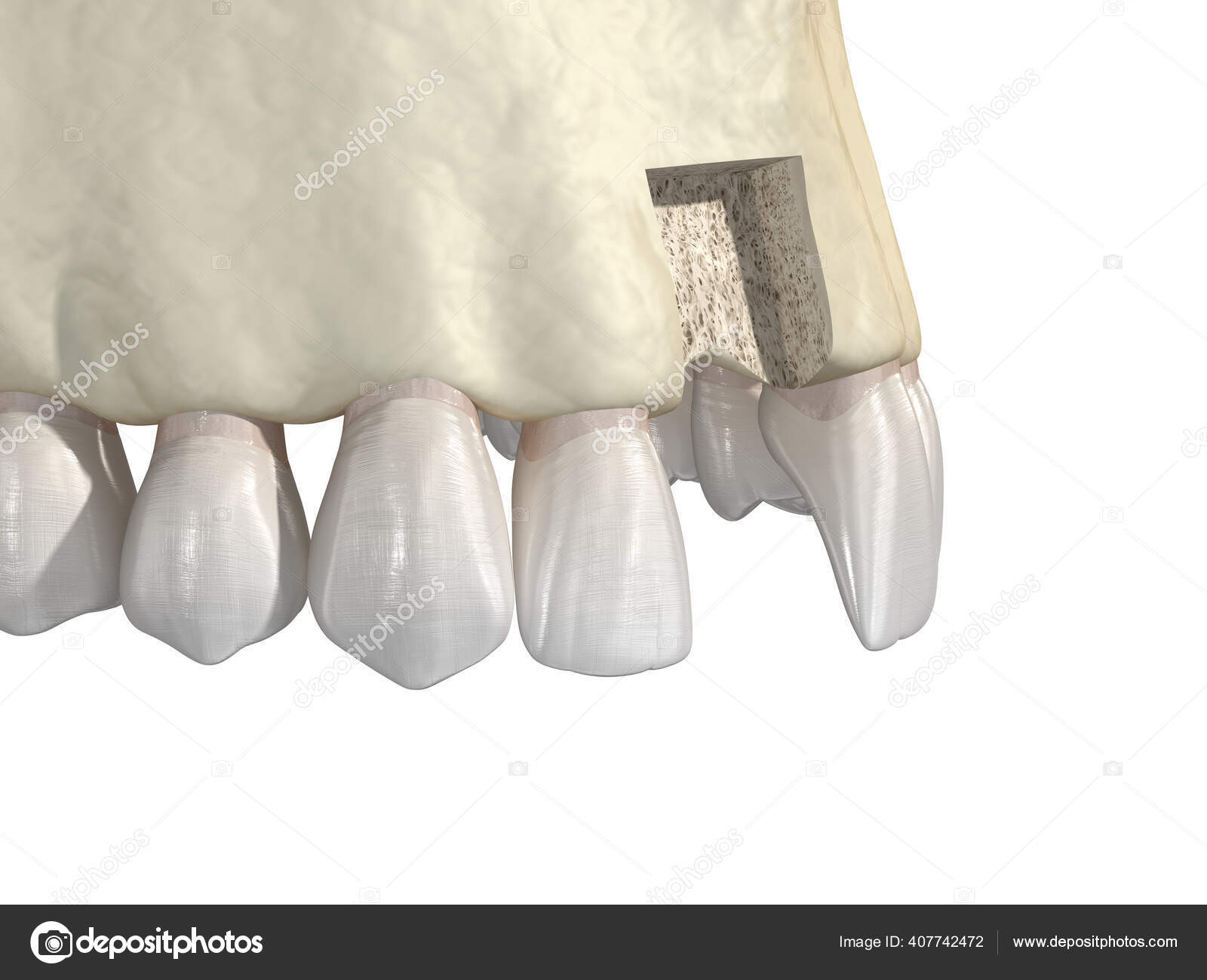Bone Grafting Augmentation Using Block Bone Tooth Implantation ...