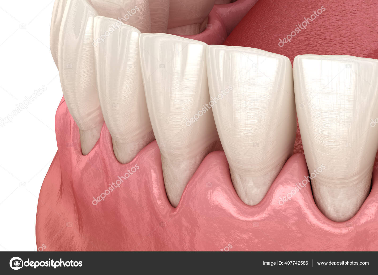 Gum Recession Process Medically Accurate Illustration Stock Photo by ...