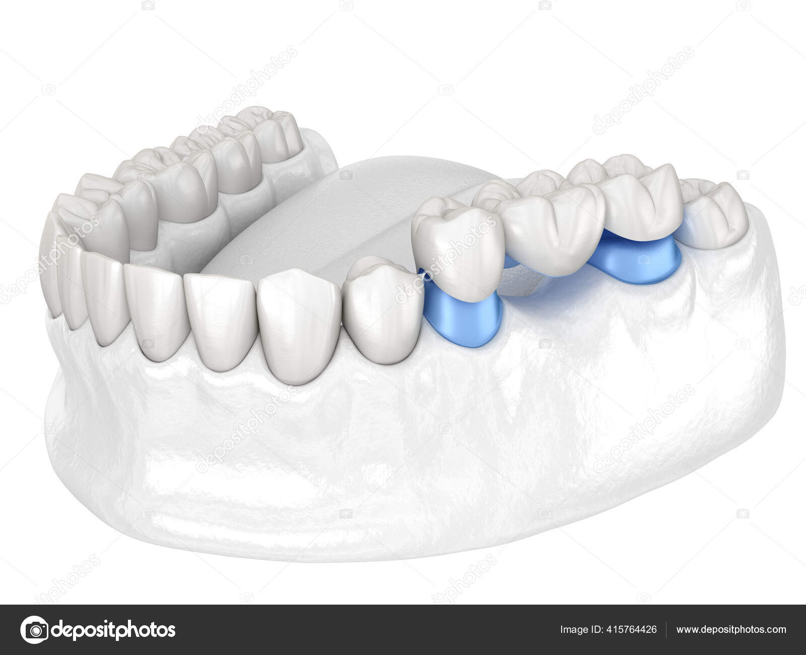 Porcelain Dental Bridge Teeth Molar Premolar Medically Accurate ...