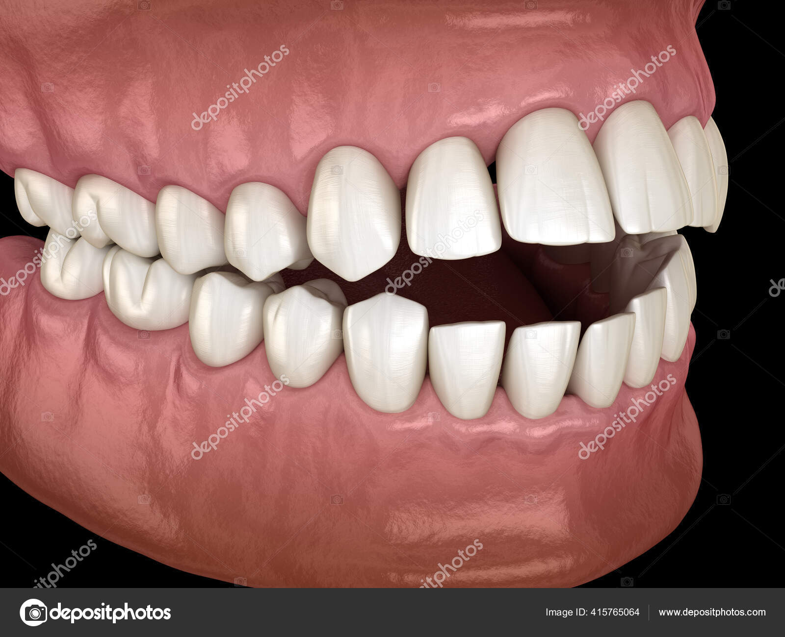 Openbite Dental Occlusion Malocclusion Teeth Medically Accurate Tooth Illustration — Stock Photo ...