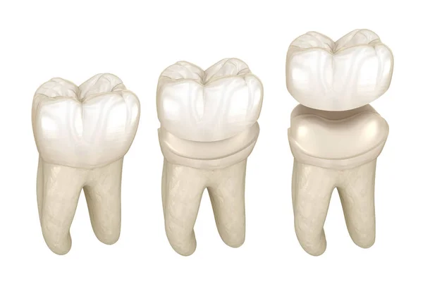 Dental Anatomy First Maxillary Molar Tooth Medically Accurate Dental ...