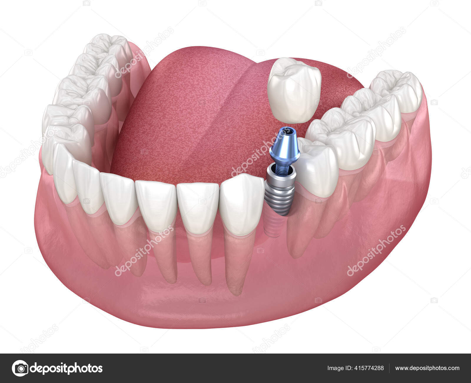 Premolar Tand Opsving Med Implantat Medicinsk Præcis Illustration ...