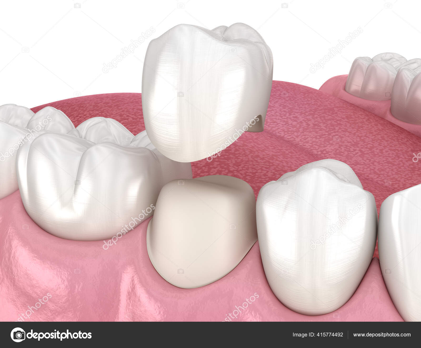 Preparated Premolar Tooth Dental Crown Placement Medically Accurate ...