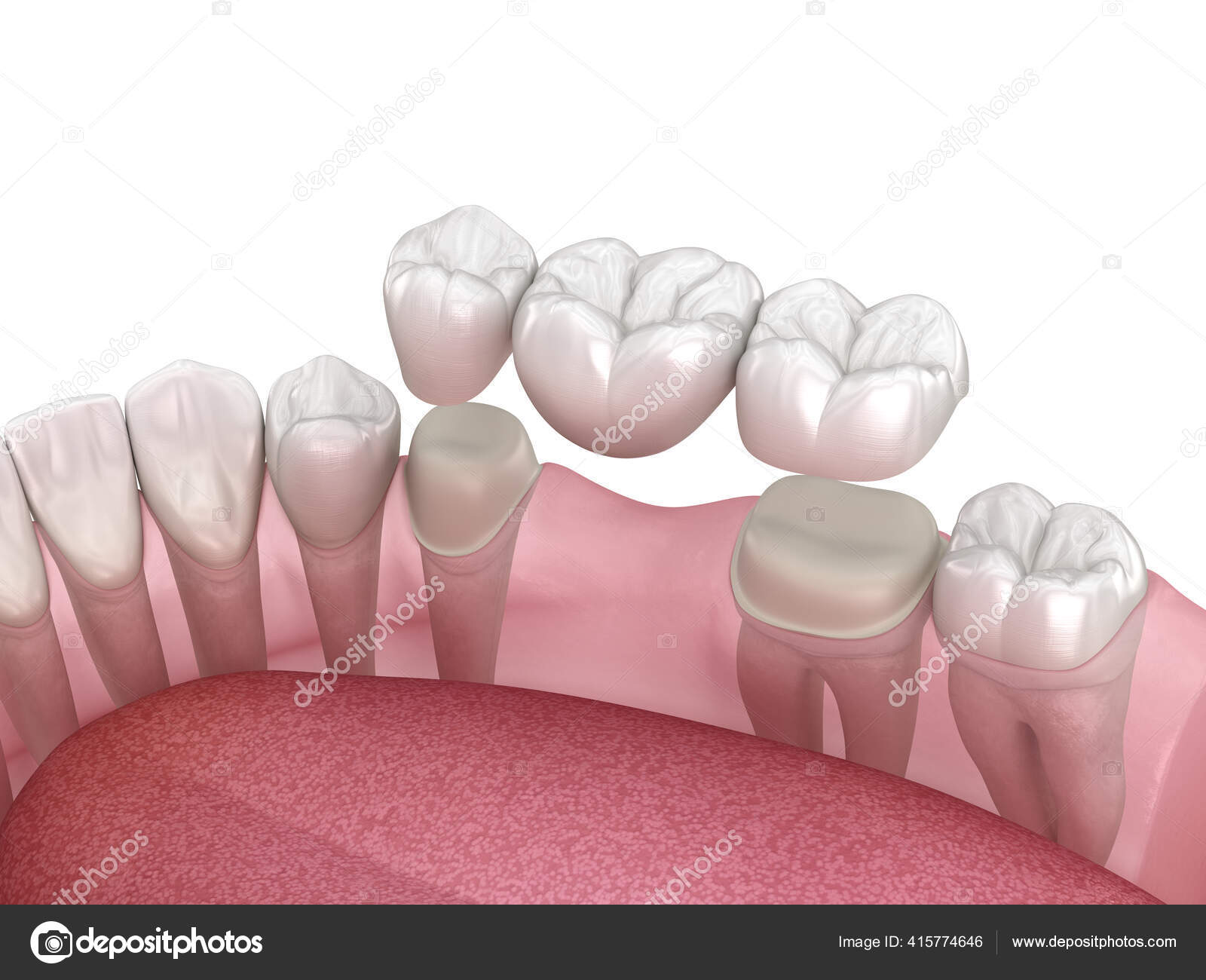 Dental Bridge Teeth Molar Premolar Medically Accurate Illustration ...