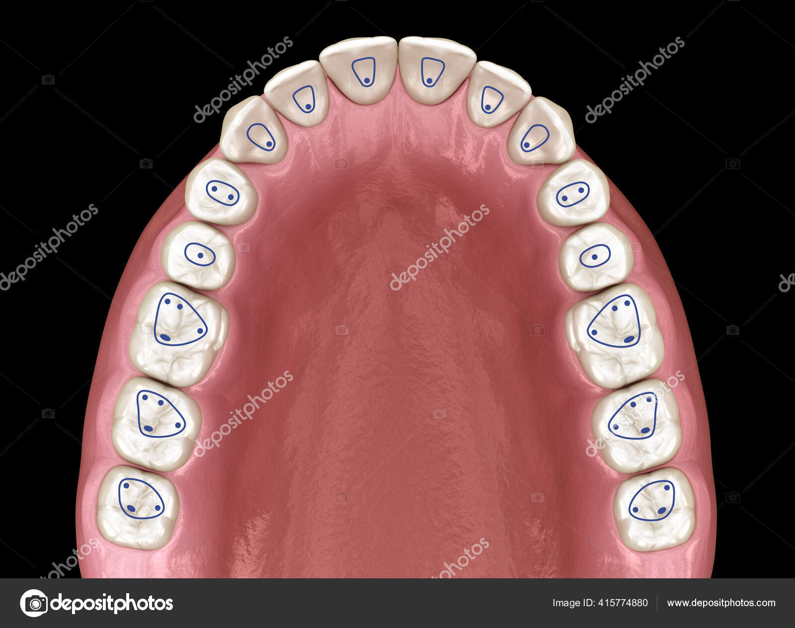 Root Canal Orifice Locations Plan Maxillary Jaw Illustration Stock ...