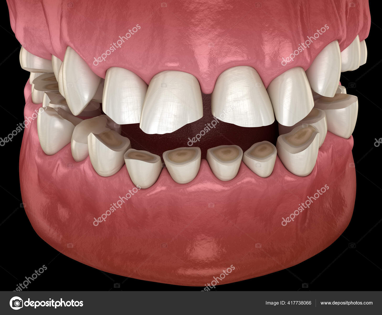 Attrition Teeth